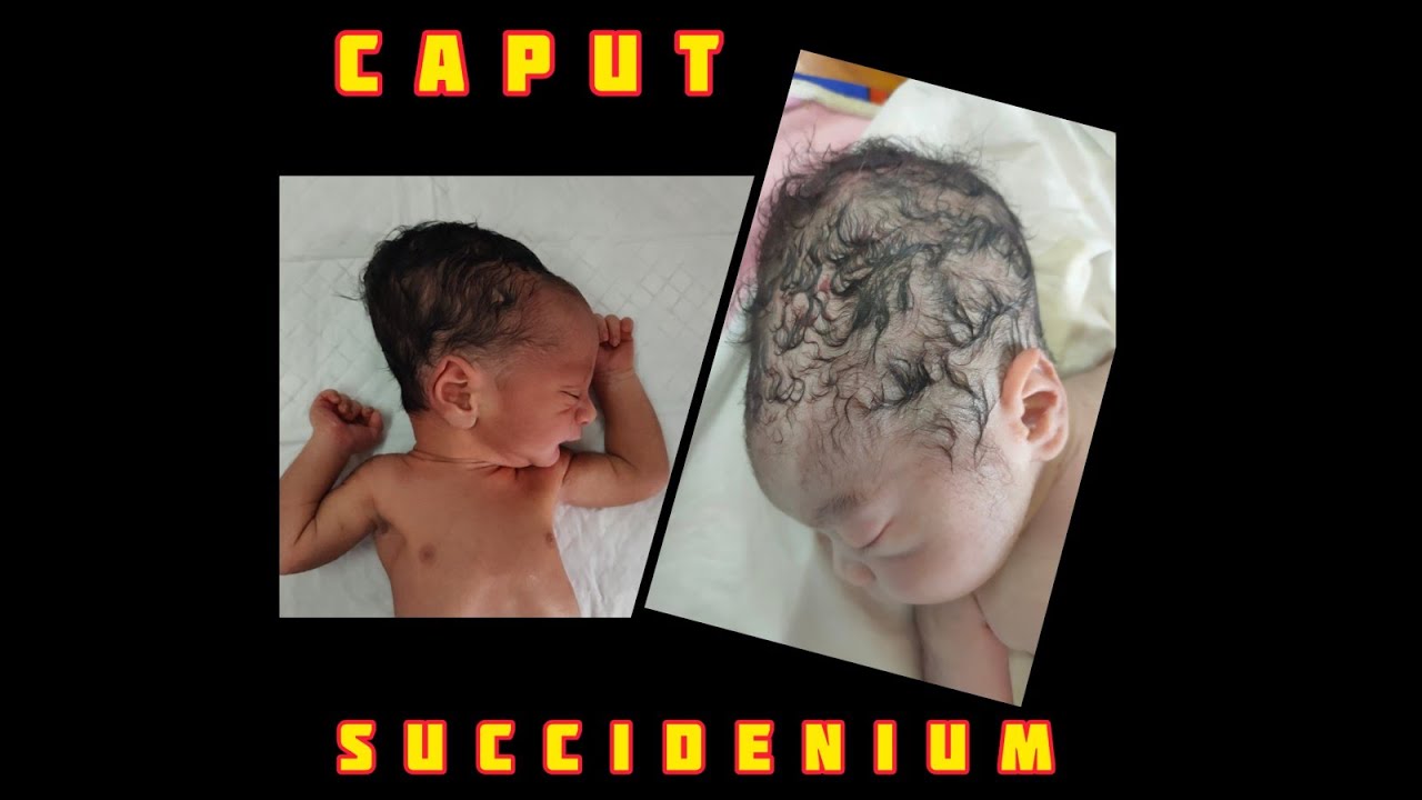 Caput Succedaneum.#newbornbaby #caput #neonatology - YouTube