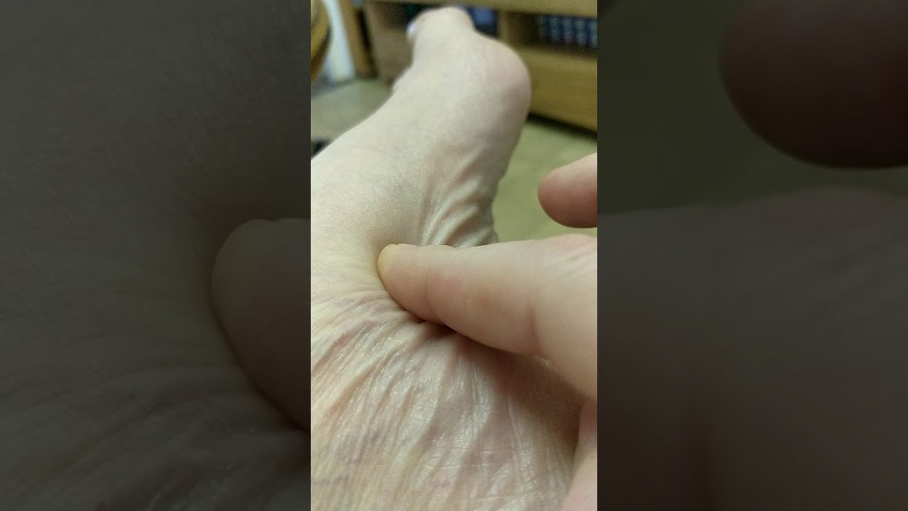 Cramp fasciculation syndrome symptom, increased twitching from direct ...