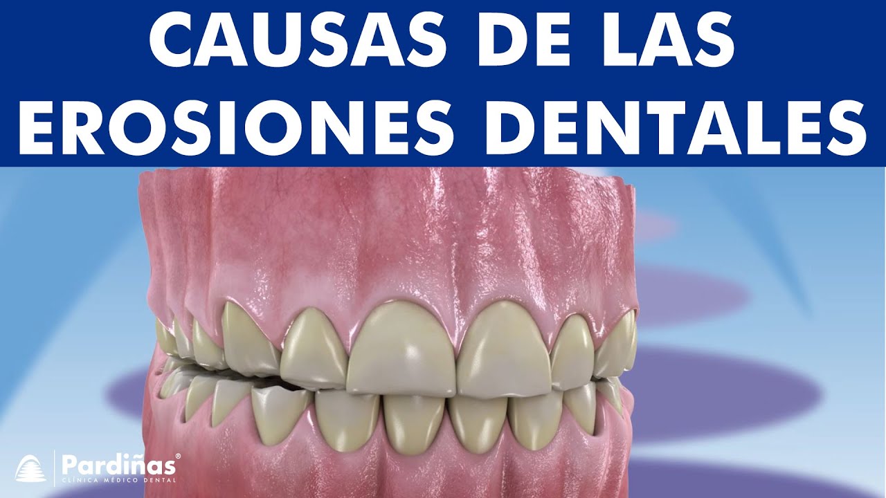 Abfracción, atrición, abrasión, reabsorción dental y otros problemas de ...