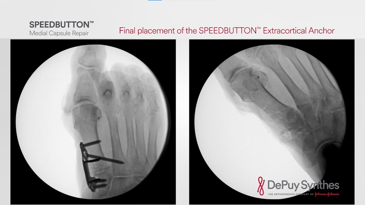 SPEEDBUTTON™ Extracortical Soft-Tissue Anchor - Cadaveric Surgical Demo ...