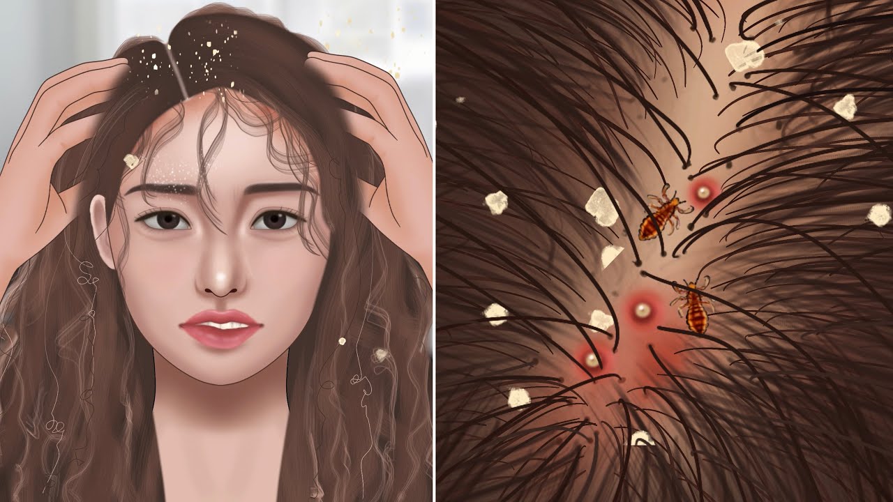 ASMR Scalp Care Animation‼️Get rid of tons of head licd, Nose Sebum ...