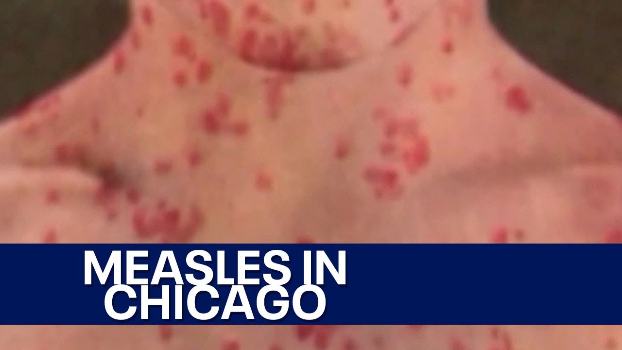 Growing concerns for migrants in Chicago after 2 cases of measles ...