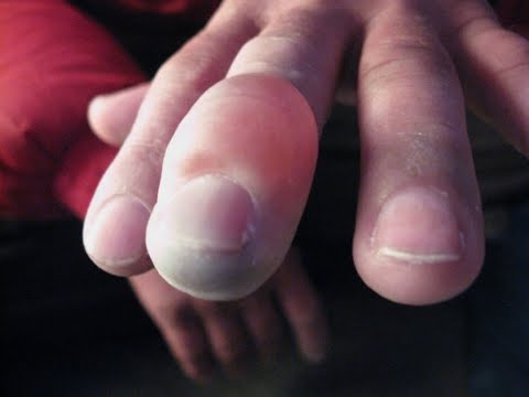 FROSTBITE - practice guidelines for the prevention and treatment - YouTube