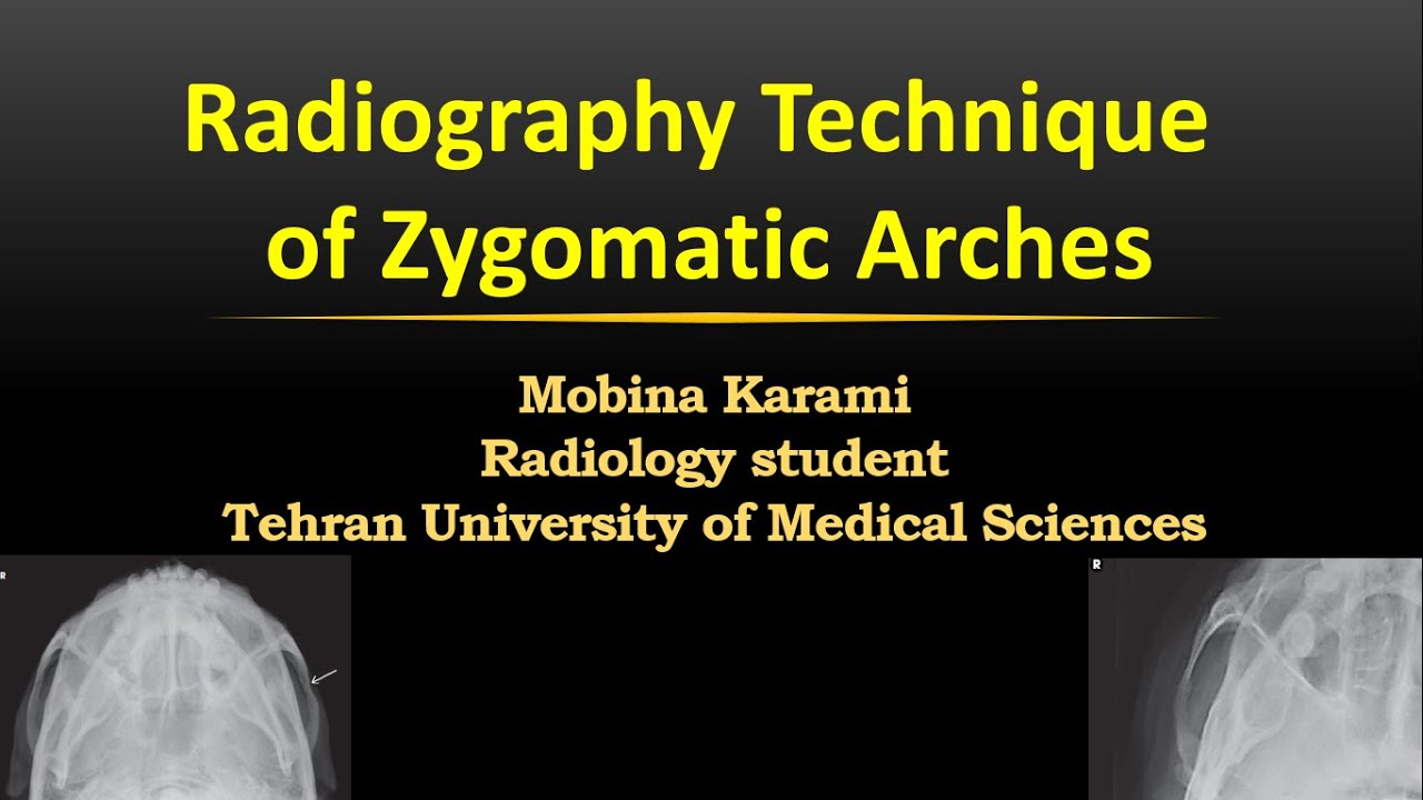 MedImag: Radiography Technique Zygomatic Arches - YouTube