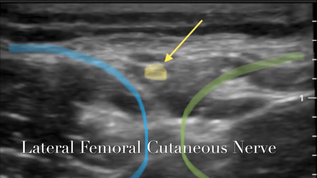 Ultrasonology of the Lateral Femoral Cutaneous Nerve - YouTube