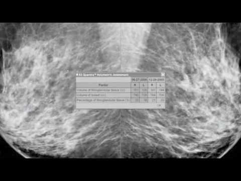 Hologic Worldwide Quantra Volumetric Breast Density Assessment - YouTube