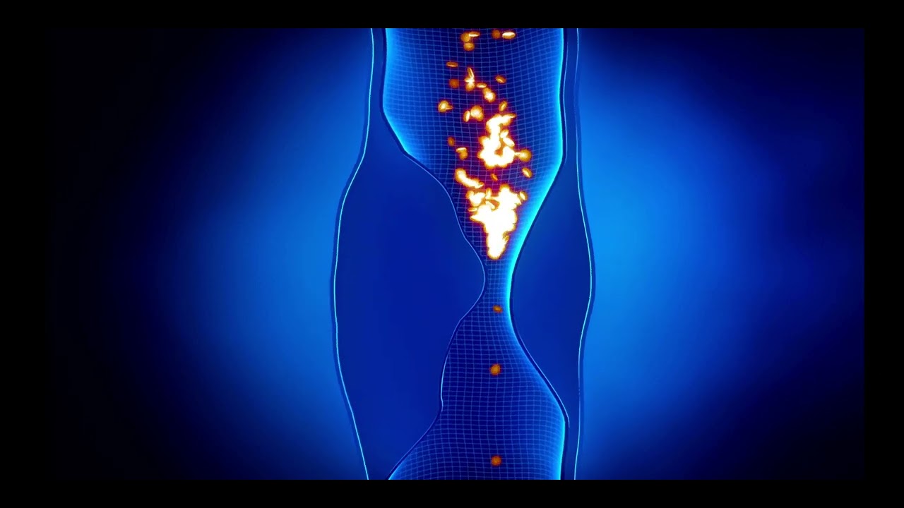 bad blood circulation in leg - PVR SYSTEM - YouTube