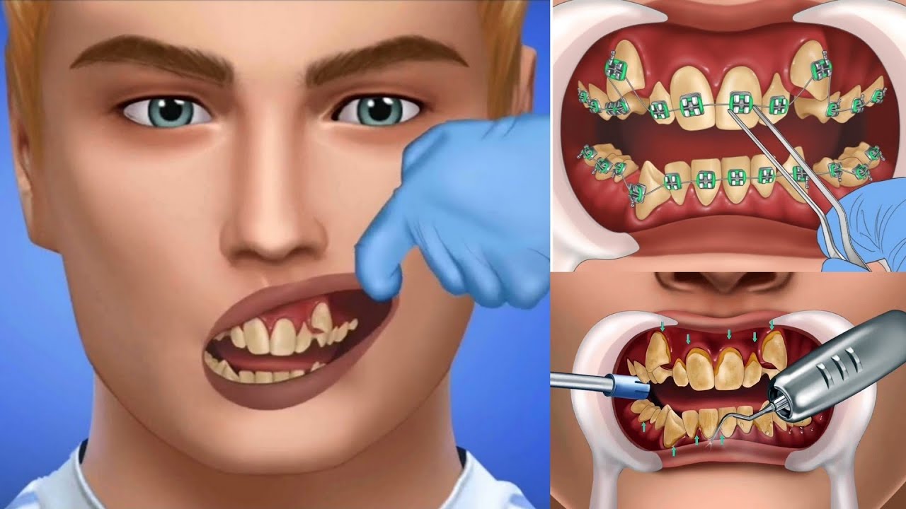 ASMR Braces Treatment|Clean up Between Teeth|Tartar Removal|Dental ...