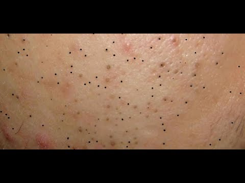 Full Blackhead Popping Video HOT 2019 Part 108 - YouTube