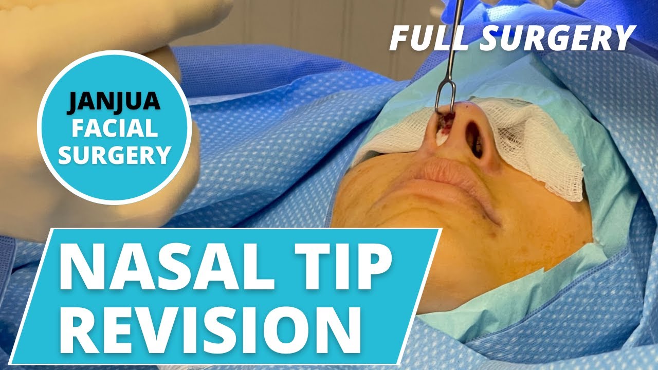 NASAL TIP REVISION ONE YEAR POST RHINOPLASTY - DR. TANVEER JANJUA - NEW ...