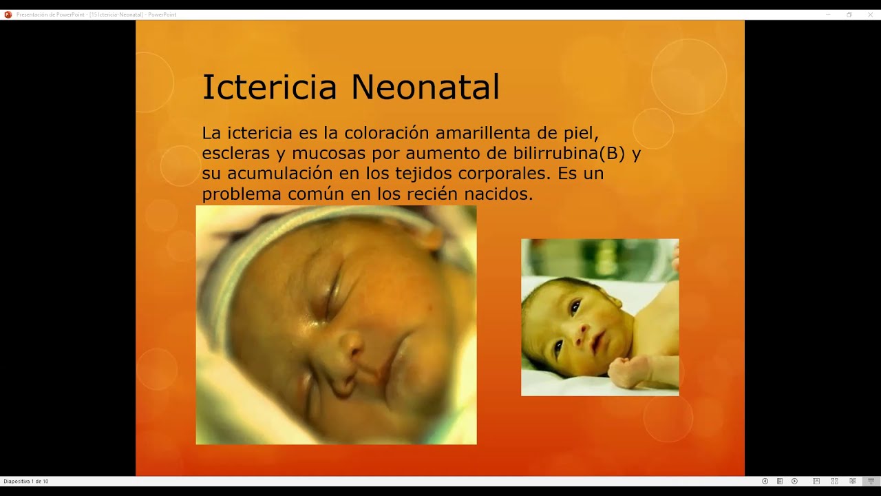 Ictericia Neonatal: Causas, Tipos, Síntomas Y Tratamiento – MWPGLA