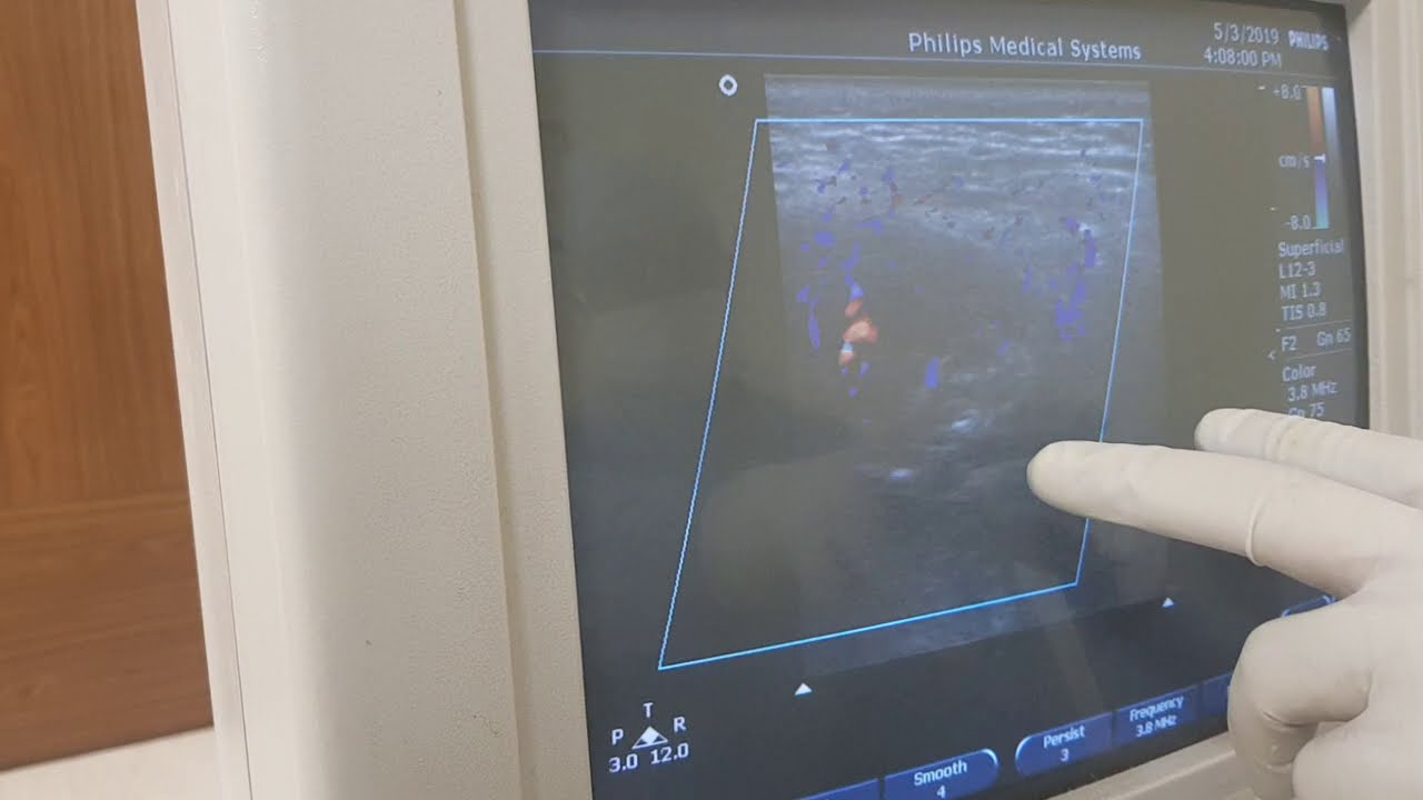 Trigeminal Neuralgia block using USG guided intervention - YouTube