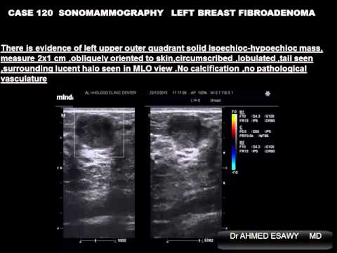 case 120 sonomammography left upper outer breast fibroadenoma - YouTube