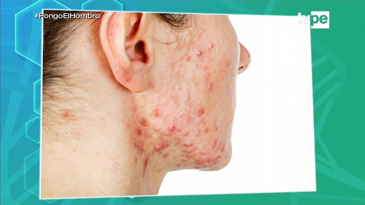 Cuerpo Médico: Acné severo (20/10/2021) | TVPerú - YouTube