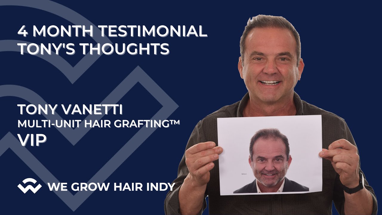 Tony Vanetti's Thoughts 4 Months After His Hair Transplant - YouTube