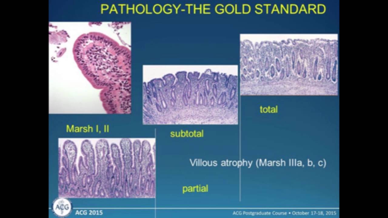 Celiac Disease and Gluten Sensitivity: Is Wheat Our Enemy? - YouTube