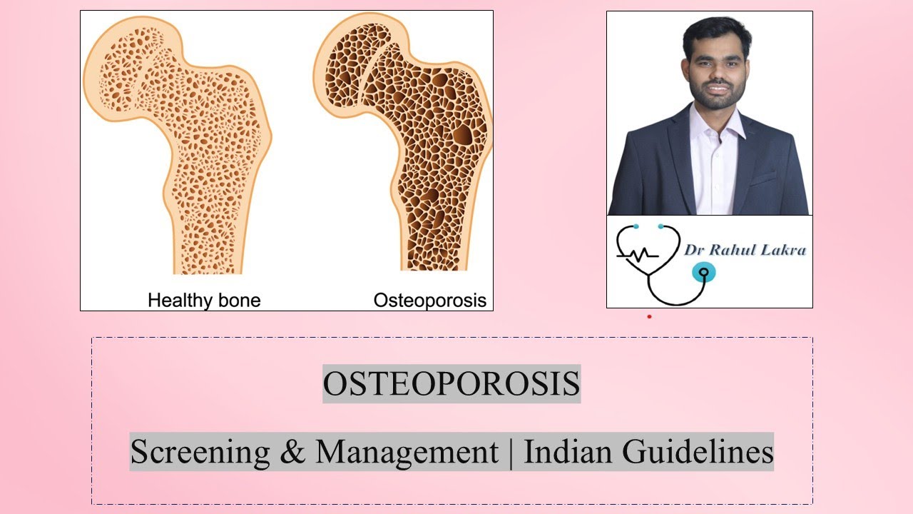 Osteoporosis | Indian Guidelines | Screening & Management | DEXA scan ...