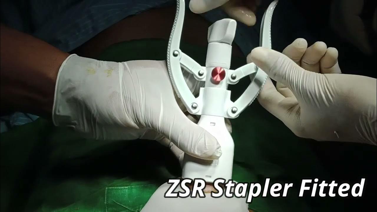 Total Phimosis Circumcision Surgery Circumcision Zsr Stapler Non