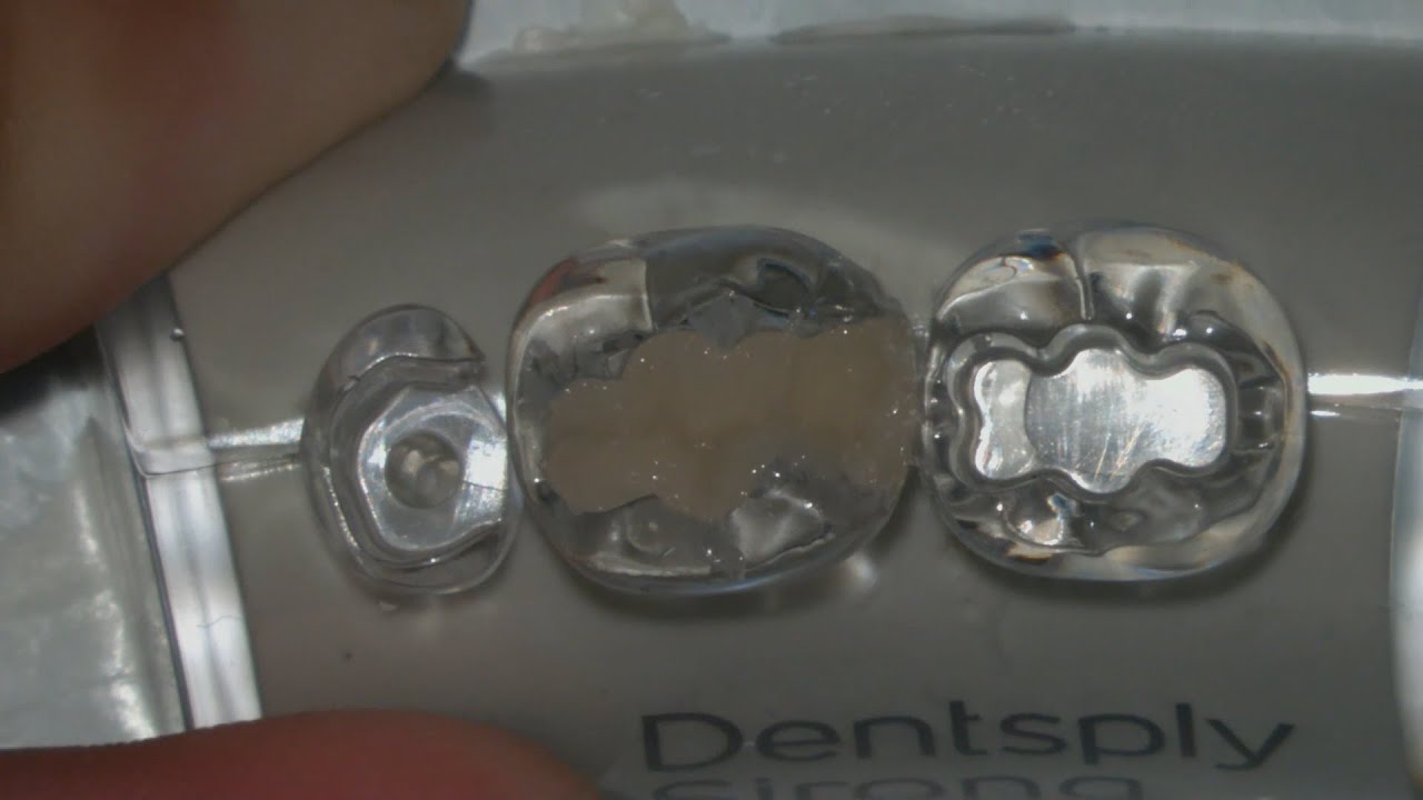 class II resin restoration - YouTube