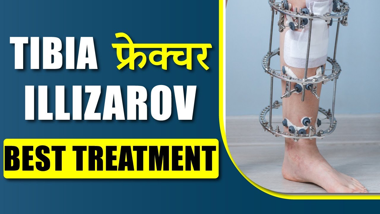 Post IIizarov Immediate Moblization | Tibia Fracture Treatment by Dr ...
