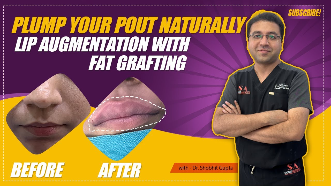Upper Lip Fat Grafting | Enhance Your Upper Lips with Upper Lip Fat ...