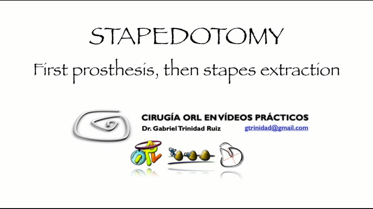 STAPEDOTOMY PLACING THE PROSTHESIS BEFORE EXTRACTING THE STAPES - YouTube
