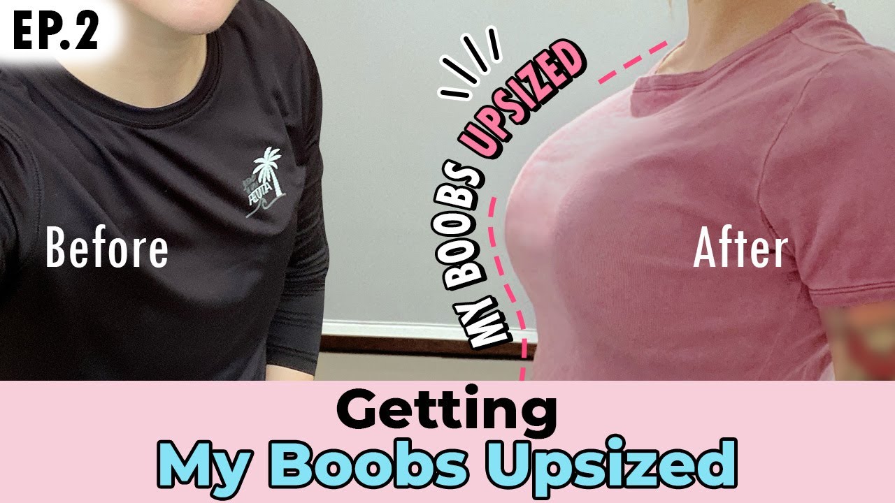 Ep2 Honest Reviews Of Breast Augmentation Recovery Tips And Updates Implant Boobjob In