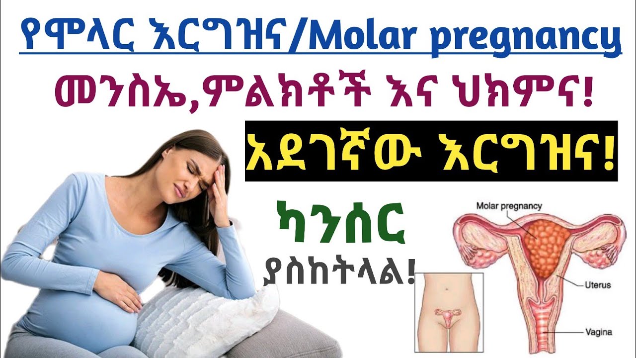 የሞላር እርግዝና ምንድን ነው? መንስኤ,ምልክቶች እና ህክምና| አደገኛው እርግዝና| What is Molar ...