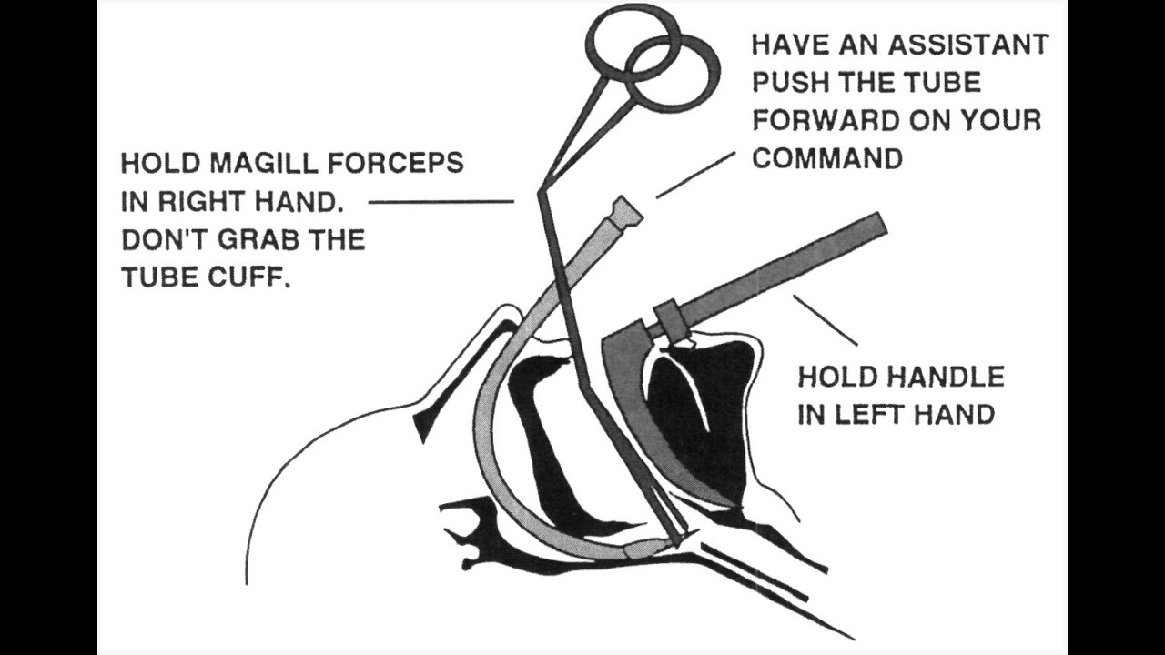 nasotracheal tube ; Definition, Uses, Nasotracheal Intubation ...
