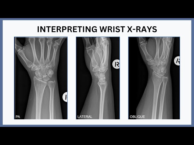 Normal Wrist X Ray PA Radiograph Of Normal Wrist | Download Scientific