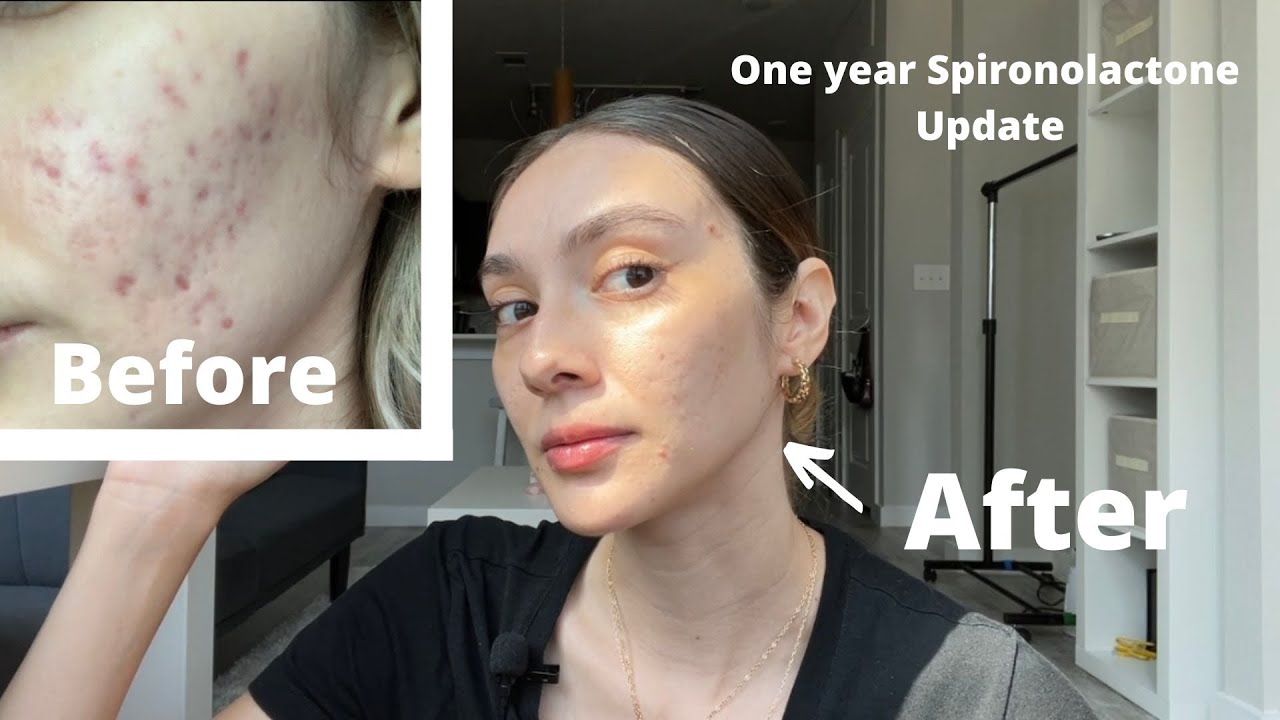 Spironolactone before and after | 1 year update for hormonal acne - YouTube