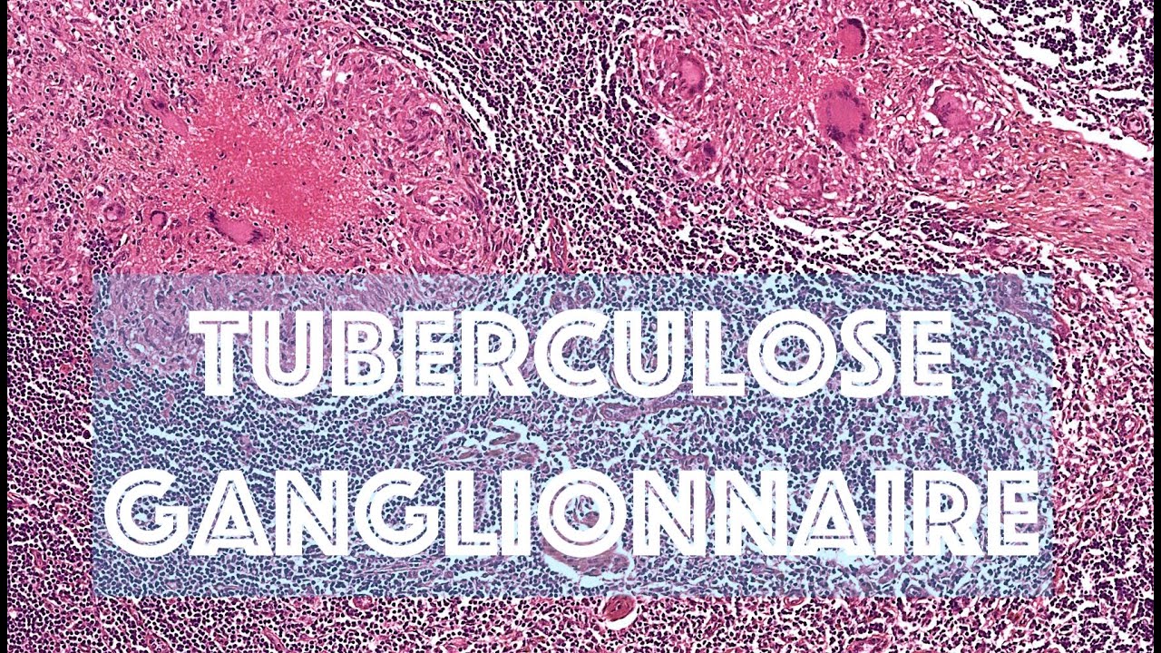 LA LYMPHADENITE TUBERCULEUSE - PATHOLOGIE - YouTube