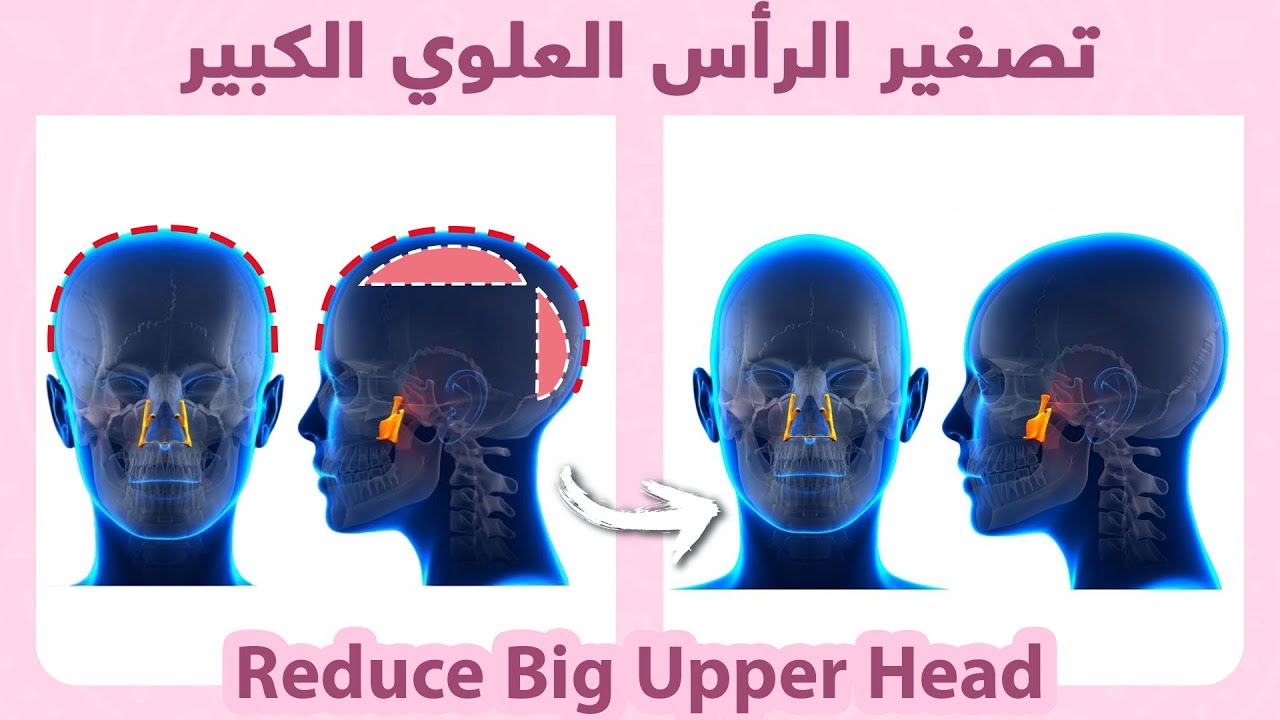 Reduce Big Upper Head - Fix Flat Head | تقليل حجم الرأس العلوي + حل ...
