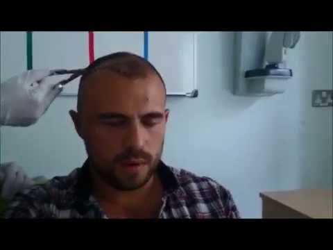 Part 8. 32 staples removed post operation for de-bulking of meningioma ...
