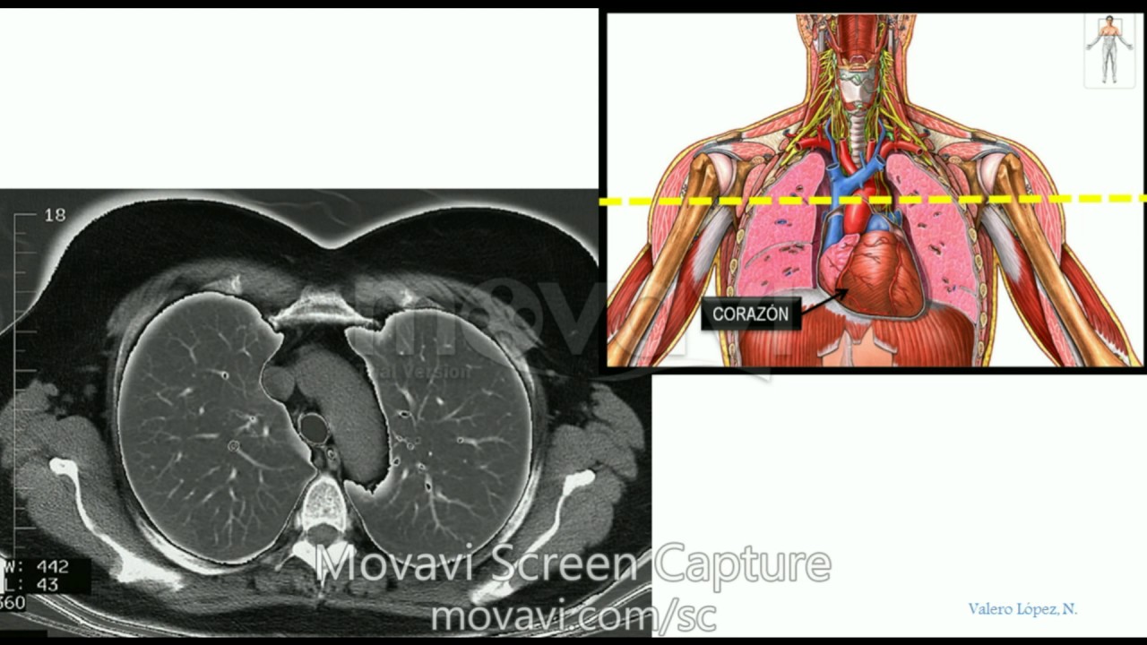 Anatomía De La Tomografía Computarizada Del Tórax Toracostomía Con