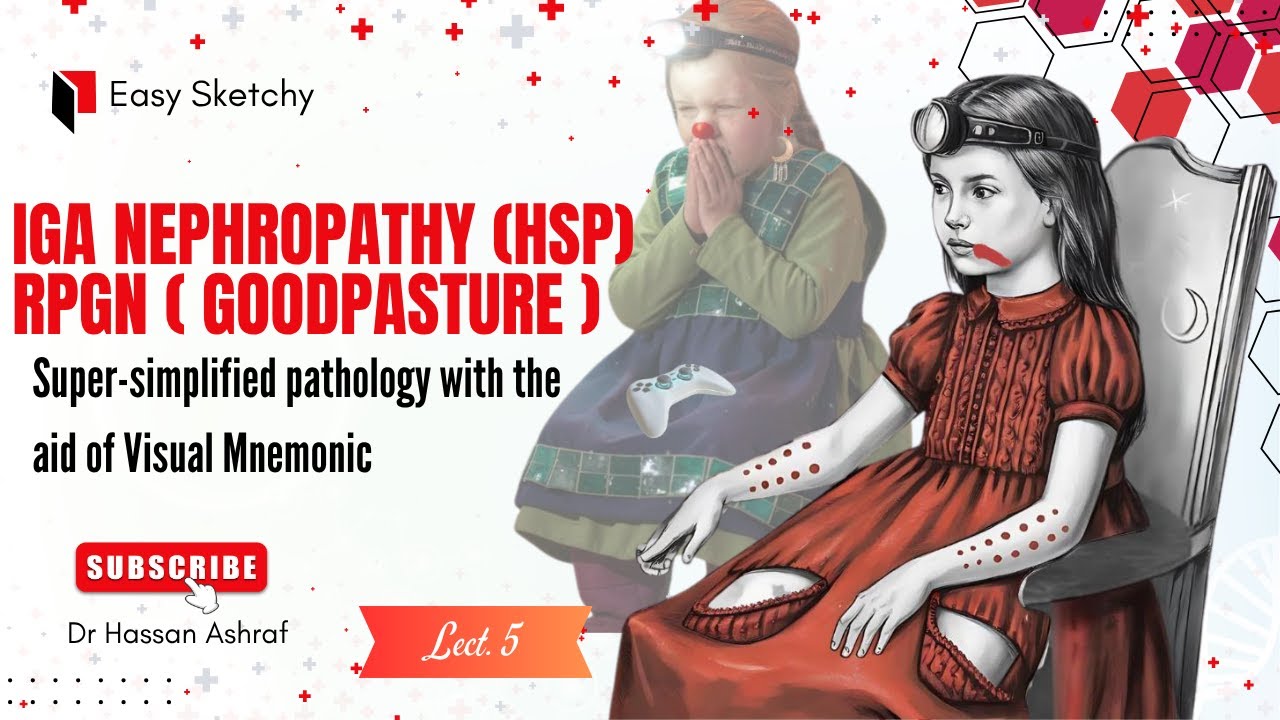 IgA Nephropathy (HSP) Pathology | RPGN (Goodpasture Syndrome ...