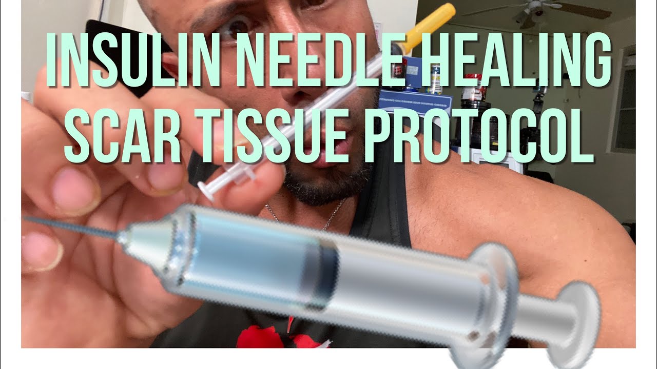 How pinning with insulin needles evenly makes a huge difference for a ...