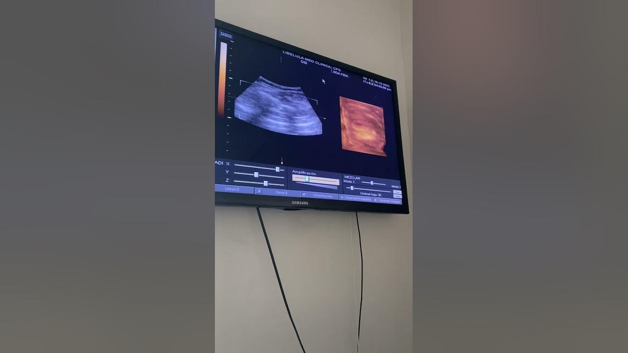 Funcionamiento Medison Sonoace 8000 Live Youtube