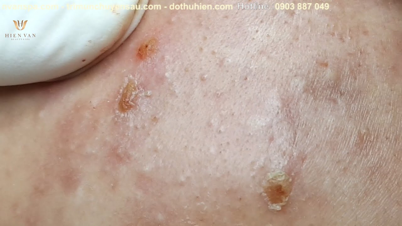 "Hidden acne,Blackheads" for a long time at hien van spa|351|T.Thúy ...