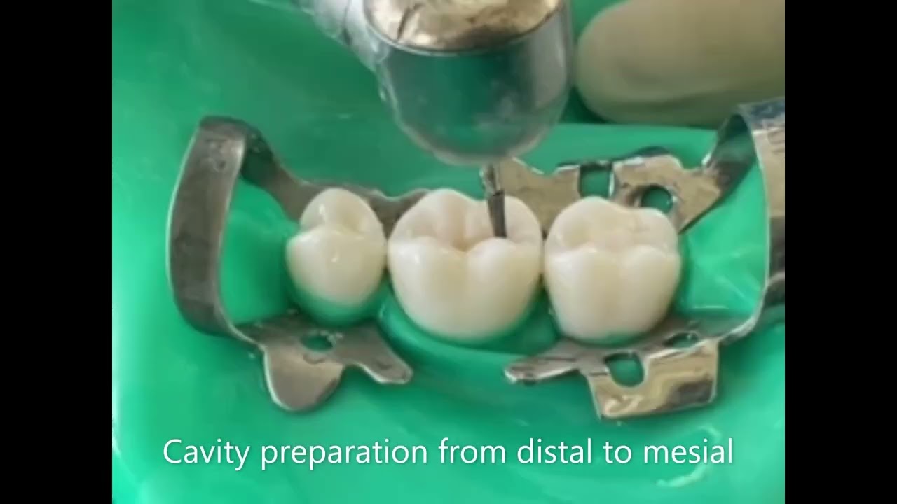 Class II Inlay cavity preparation - YouTube