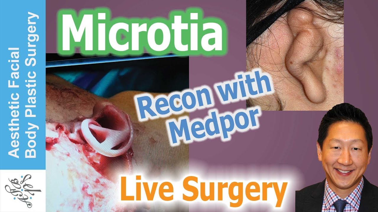 MICROTIA PEANUT CONGENITAL EAR ANOMALY RECONSTRUCTION WITH MEDPOR ...