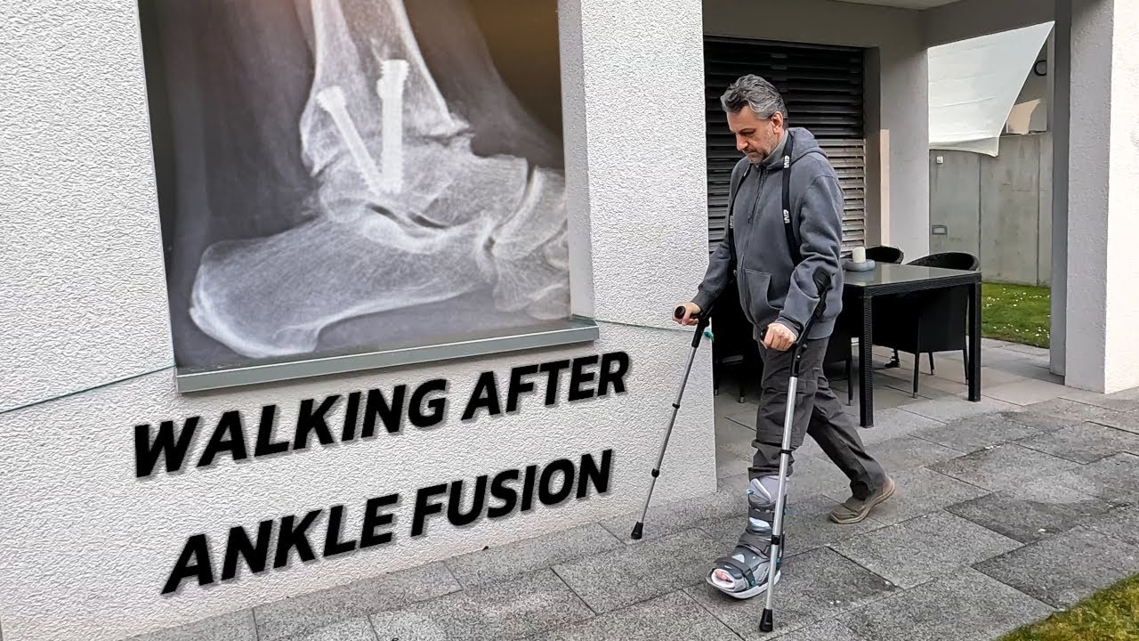 Walking After Ankle Fusion YouTube