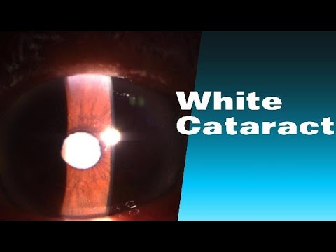 Dr Kien White Cataract Capsulorhexis Technique #18 - YouTube