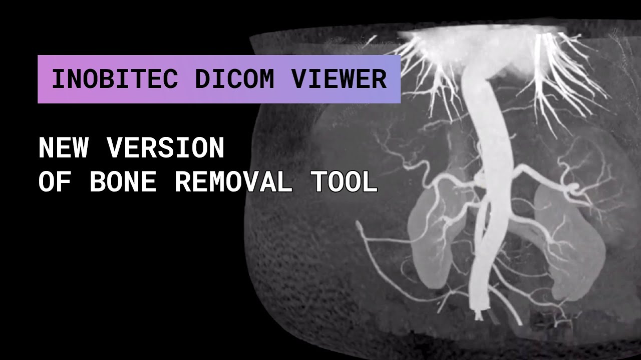 New version of bone removal tool - YouTube