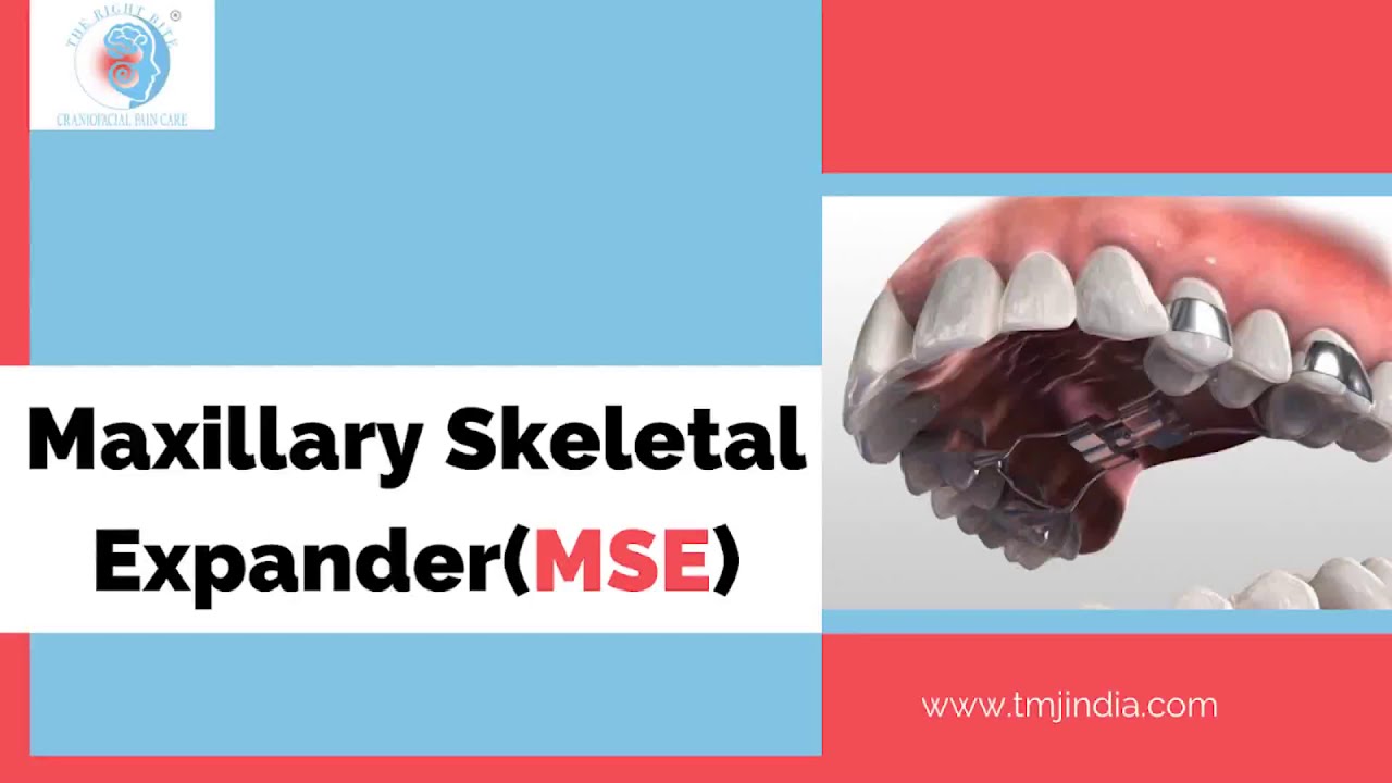 Maxillary Skeletal Expander: How it Works?| Best Maxillary Skeletal ...