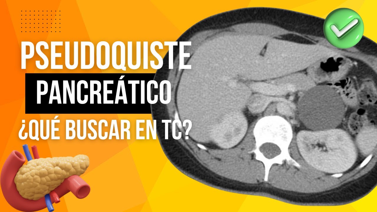 Análisis de Pseudoquiste Pancreático en TC: Guía Práctica en menos de 8 ...