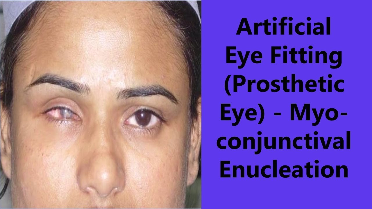 Myo Conjunctival Enucleation Surgery For Shrunken Blind Eye | The ...