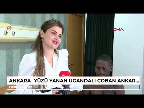 Ankara- Yüzü yanan Ugandalı çoban Ankara'da tedavi edildi /Video eklendi