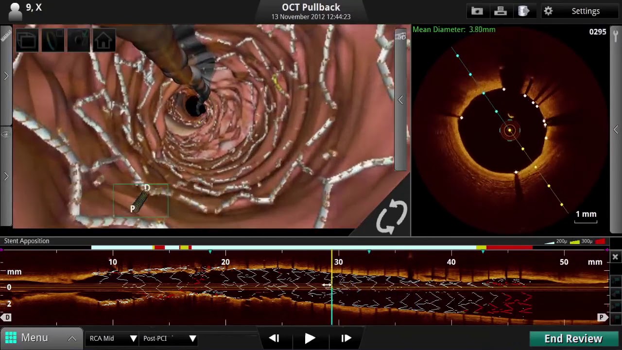 ABBOTT OPTIS INTEGRATED™ - YouTube