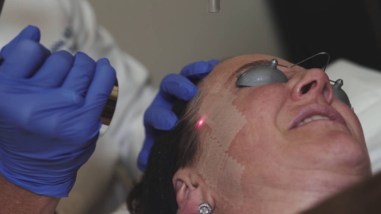 Microlaser Peel - YouTube